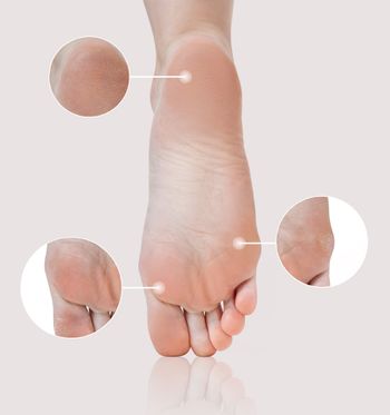 Calluses | O'Driscoll's Podiatry | Cork | Chiropodist